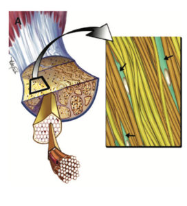Achilles Tendinopathy | Everything You Need to Know | Physiotherapy